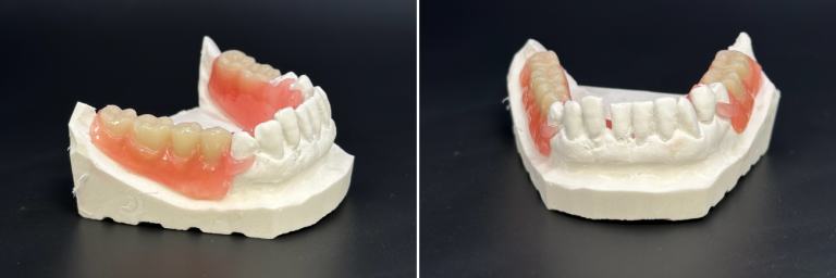 Prothèse partielle de type Valplast